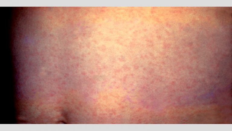 Dermoid v epidermoid cysts: what are the differences? – Anxiety ...